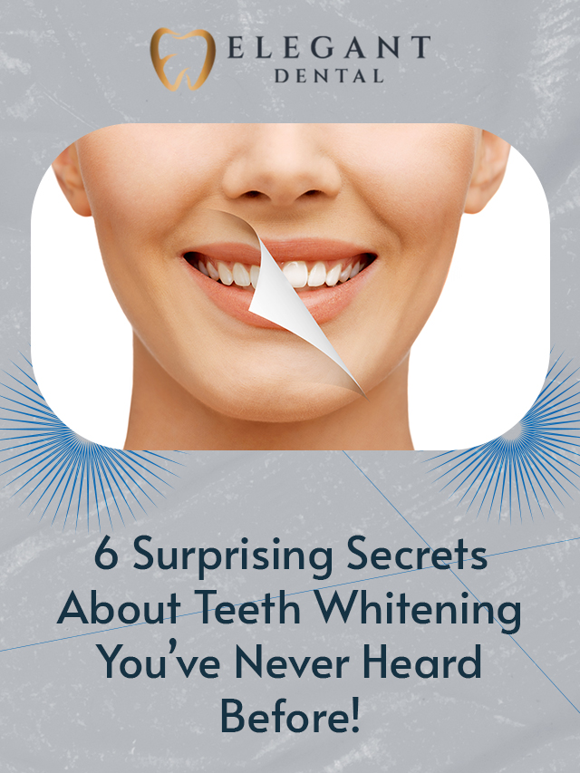 6 Surprising Secrets About Teeth Whitening You’ve Never Heard Before ...